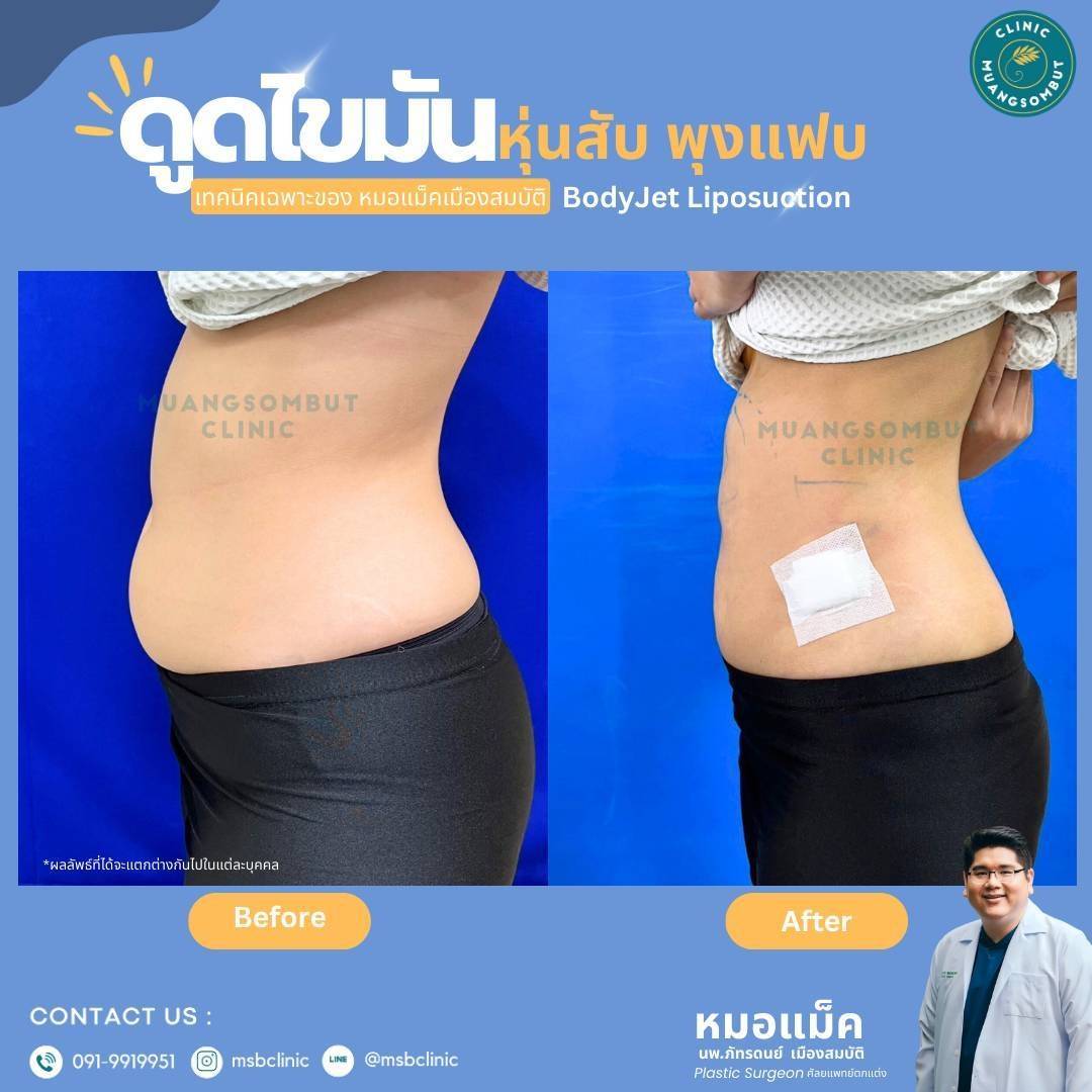 Body Jet Liposuction - MUANGSOMBUT CLINIC